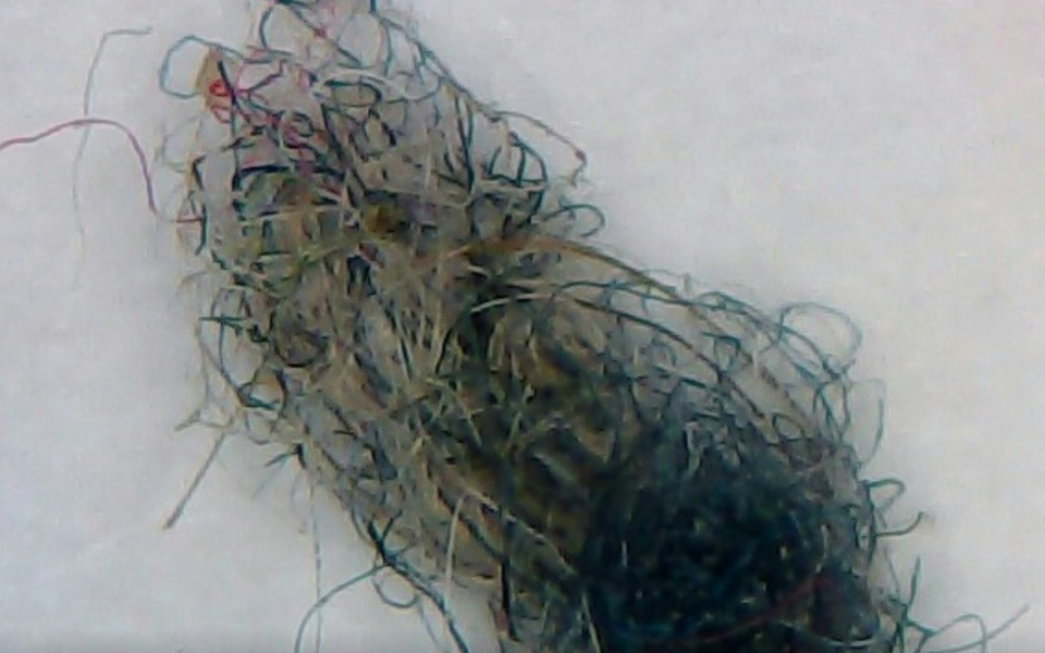 Morgellons Diseease | Morgellons Disease The Silent Pandemic